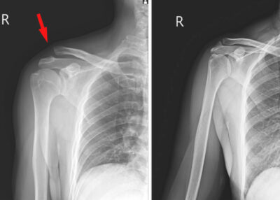 AC Joint Repair | Reconstruction | Orthopedic Shoulder Doctor | Sugar ...