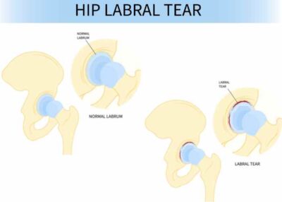 Torn Hip Labrum (Labral Tear) | Orthopedic Hip Specialist | Sugar Land ...