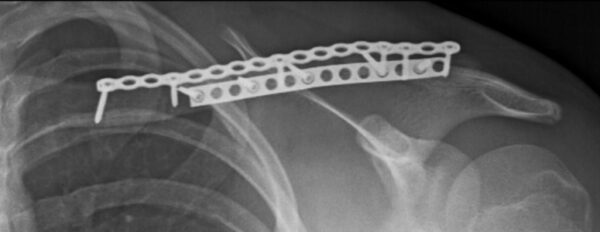 Clavicle Fracture Repair | ORIF Doctor | Sugar Land, Pearland, Houston, TX