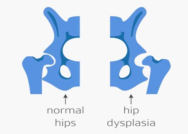 Hip Dysplasia | Orthopedic Specialist | Sugar Land, Pearland, Houston, TX