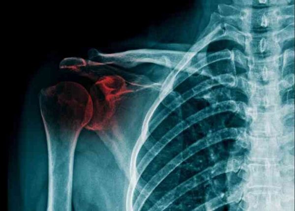 Shoulder Fracture | Broken Clavicle, Humerus, Scapula Specialist ...