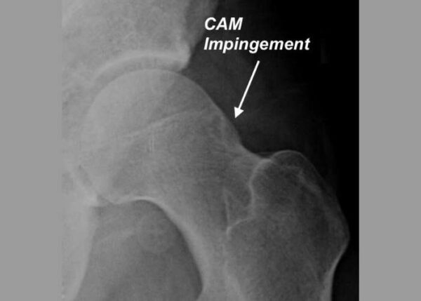 CAM Hip Impingement, Cam Deformity in the Hip - Ronak Mukesh Patel MD ...